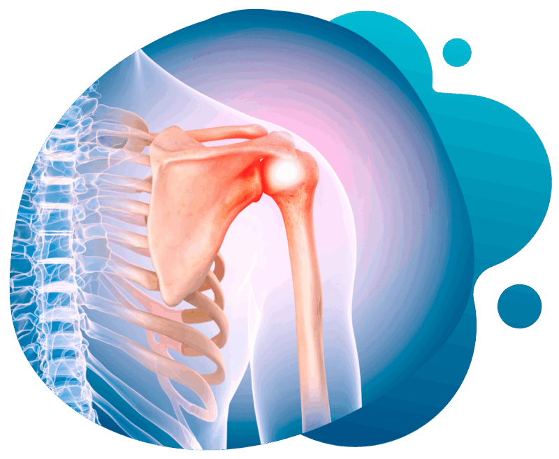 Are You Struggling with Rotator Cuff Tendinopathy?
